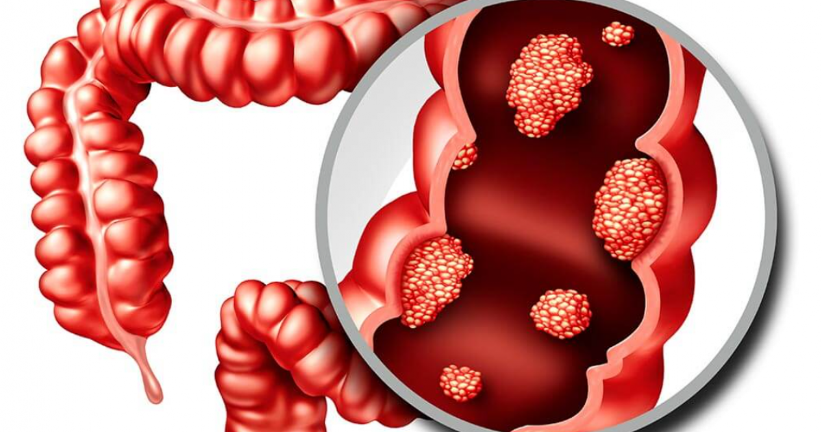 Всесвітній день боротьби з нейроендокринним раком | GreenPost
